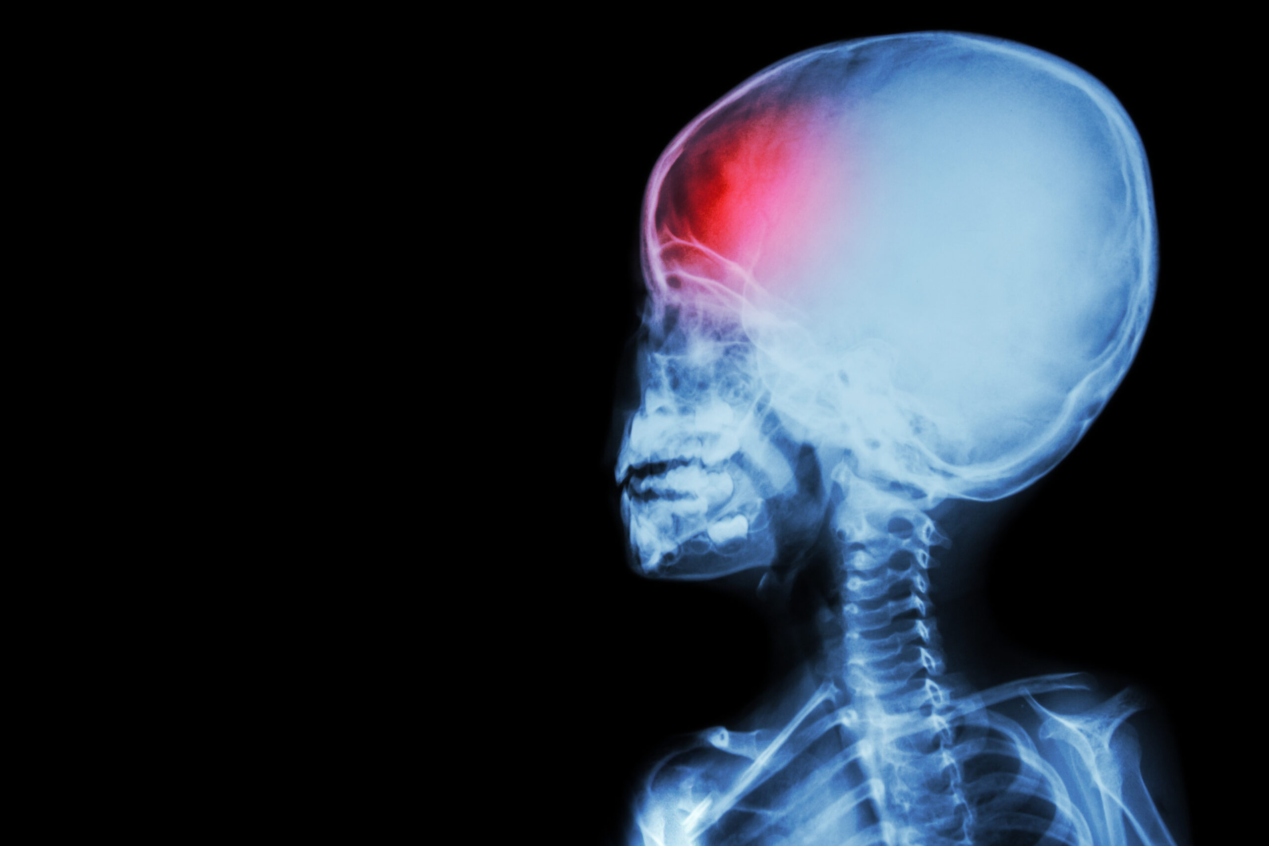 How to Recover Compensation for Your Child’s Brain Injury How to Recover Compensation for Your Child’s Brain Injury